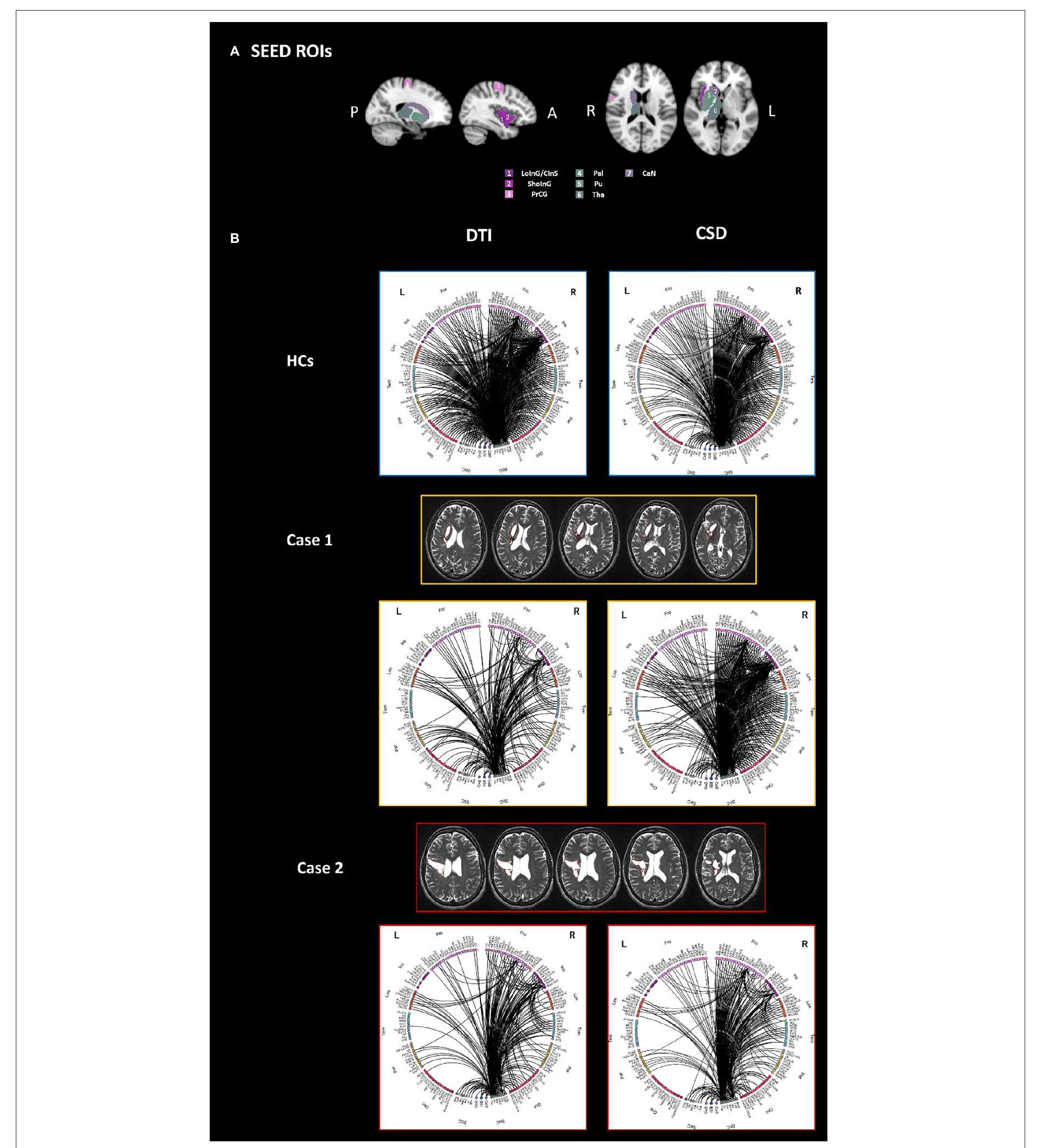 | the connectograms (b) derived by both dti (left) and csd