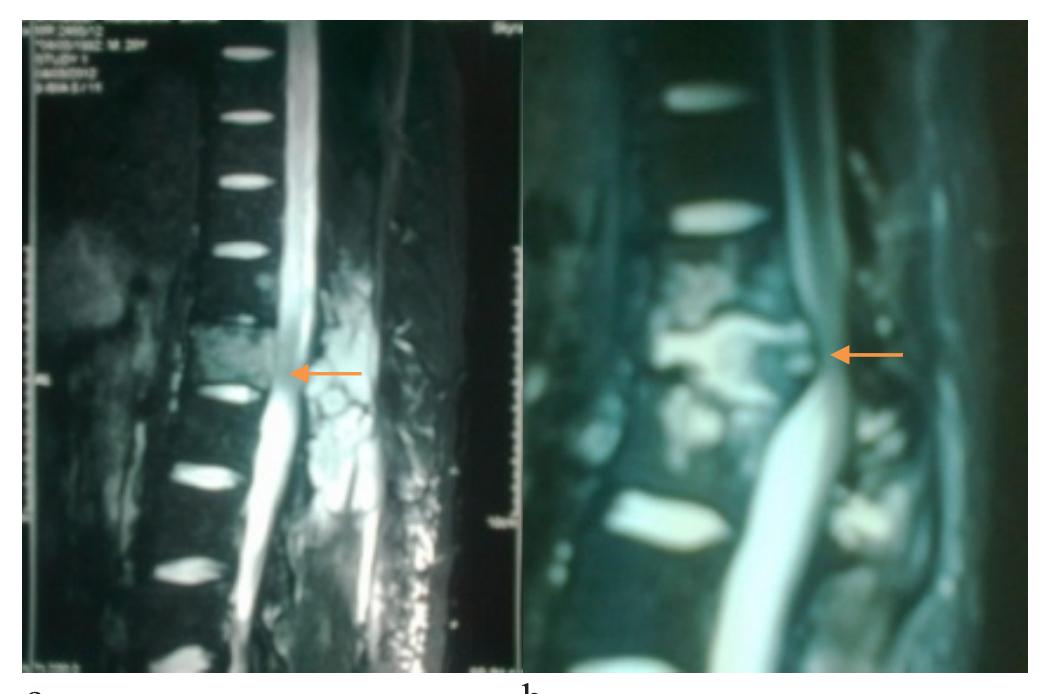 Mri scans of the thoraco lumbar spine before (a) and after