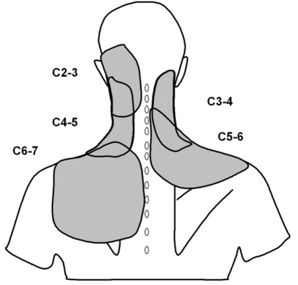 Patterns of referred pain from the cervical zygapophy- sial