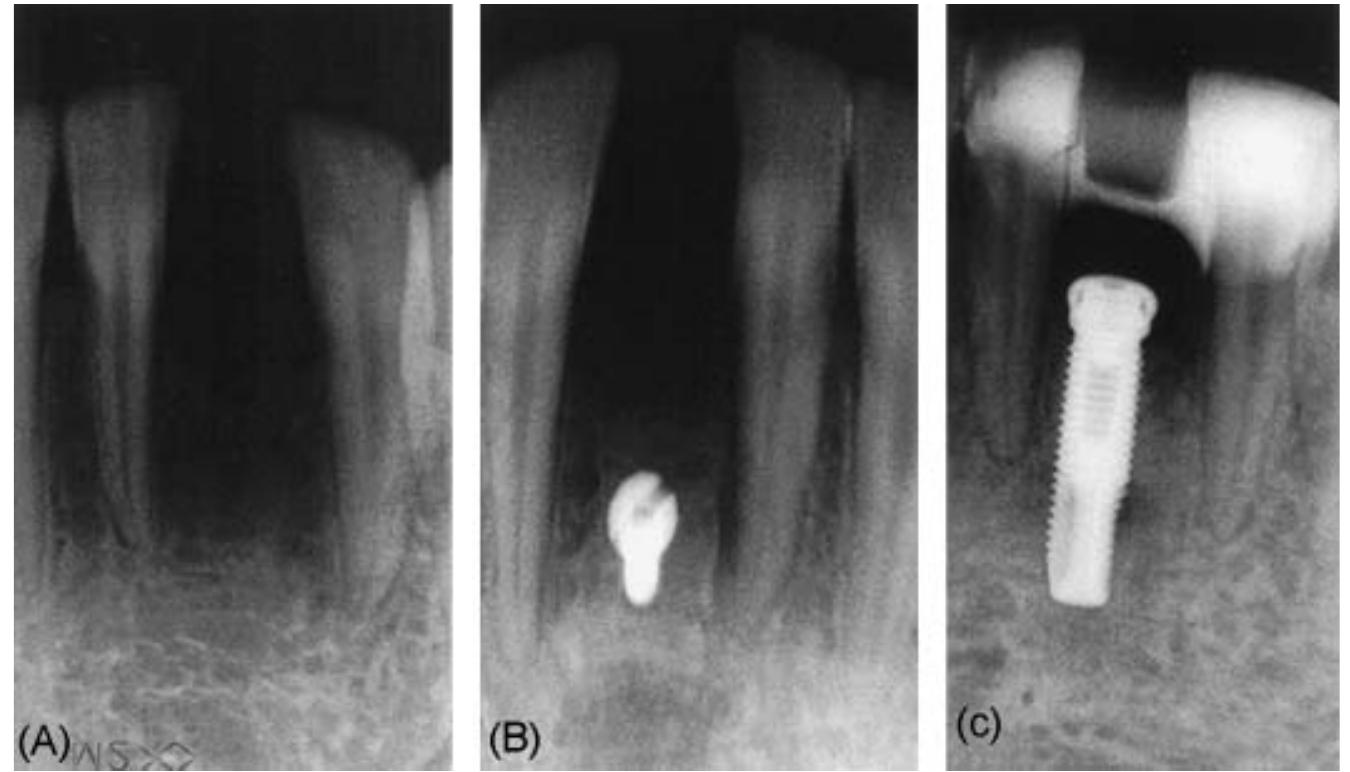 Mandibular ramus and symphysis, extraction sites, and