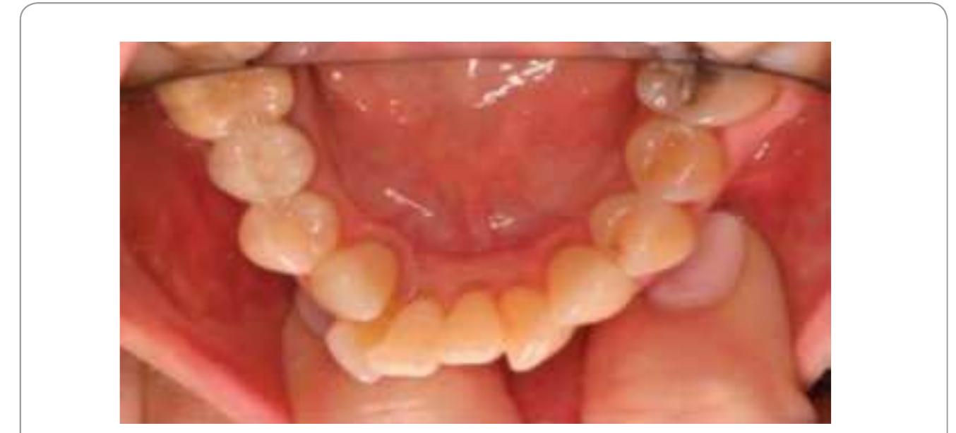 (PDF) Interproximal Reduction in Orthodontics: A literature review