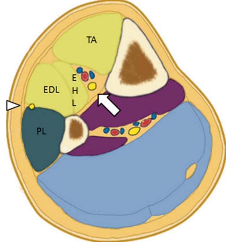Schematic drawing of a cross section of the right lower leg.