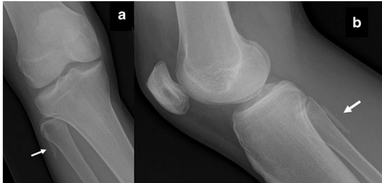 Figure 5 - from Peroneal nerve: Normal anatomy and
