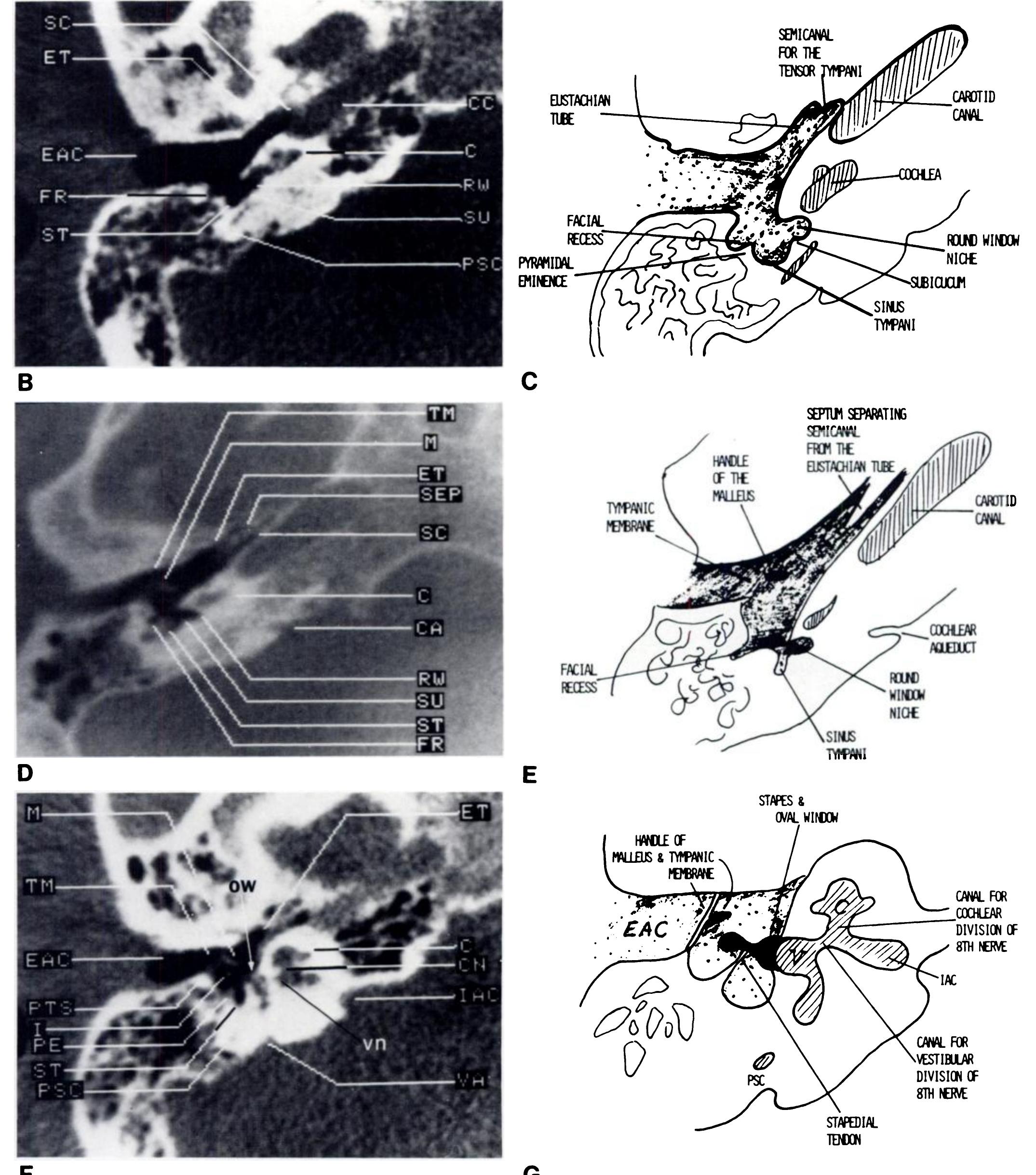 —a-g. a, coronal section of right temporal bone shows levels