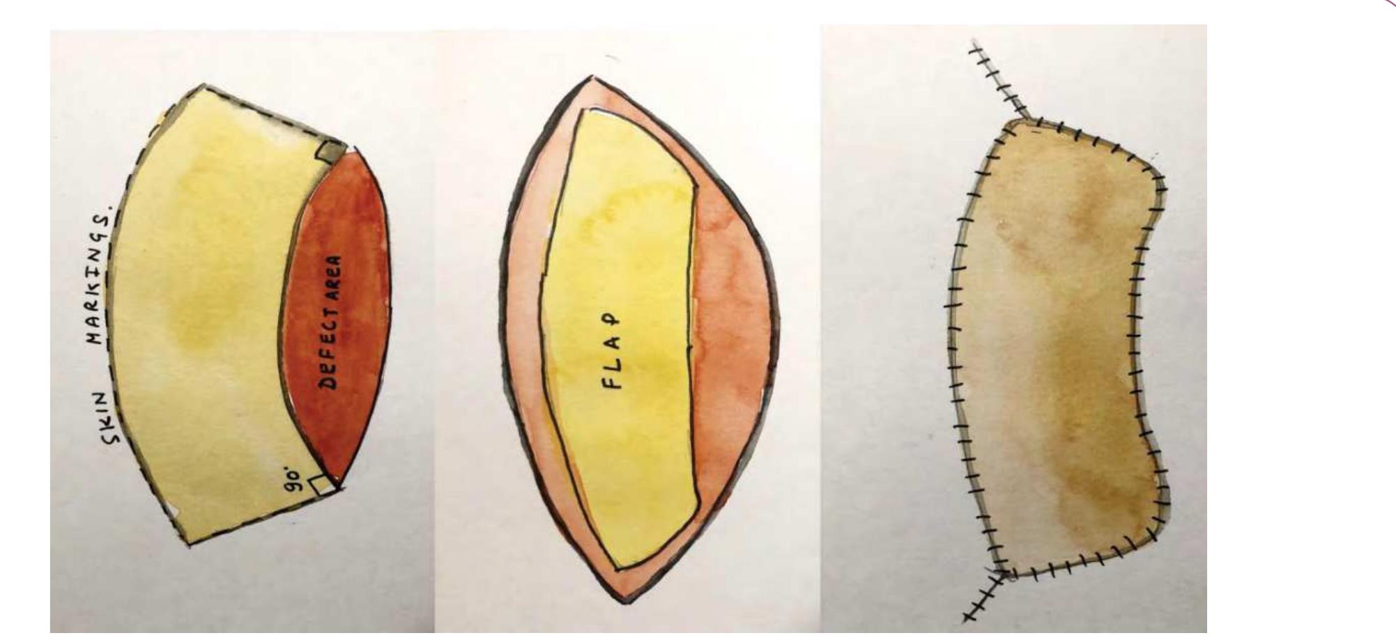 Diagrammatic representation of a keystone flap.