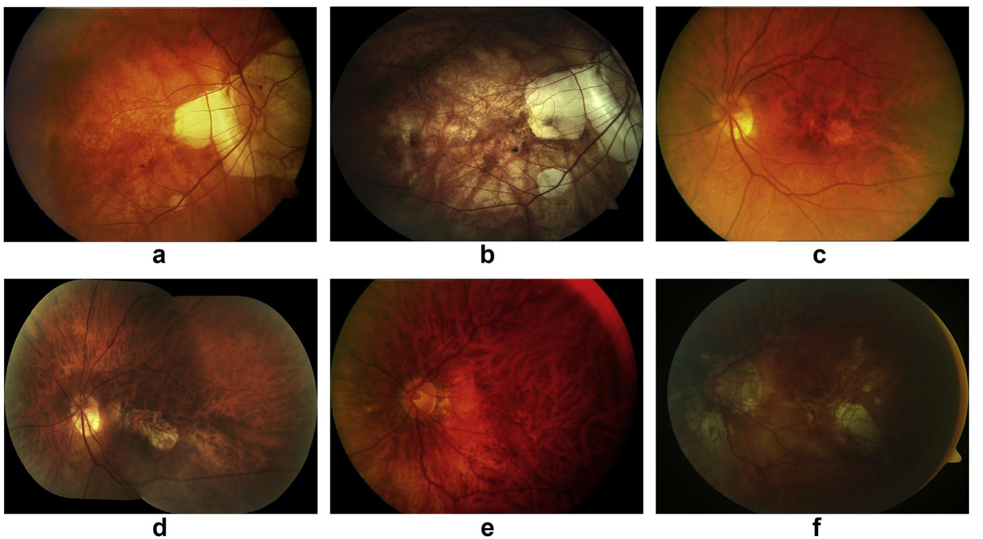 Chorioretinal atrophy progression patterns associated with