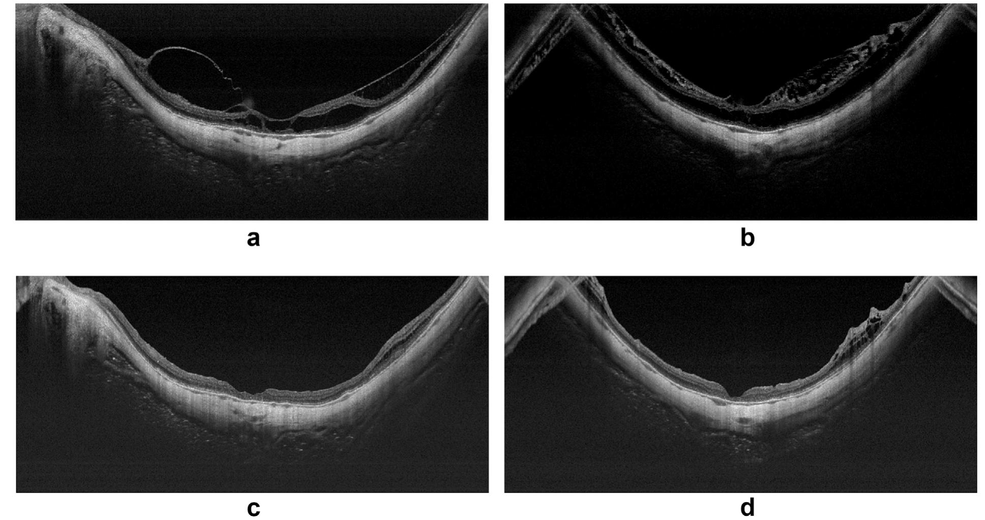 Horizontal (a, b) and vertical (c, d) optical coherence