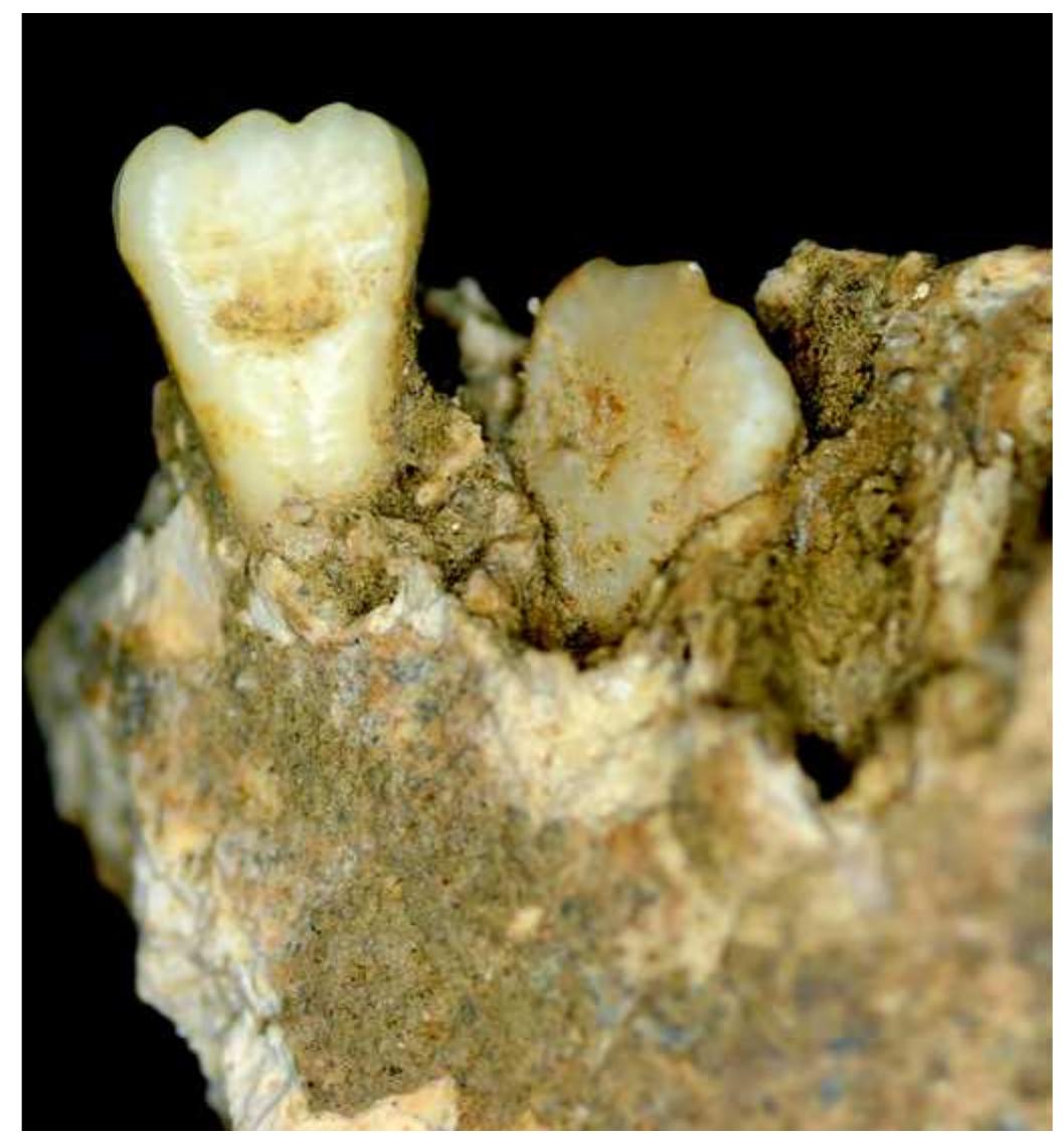 Deciduous left maxillary lateral incisor with a lingual