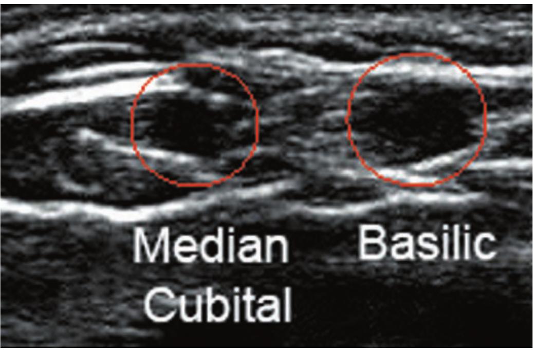 Figure 4 - PICC Zone Insertion Method™ (ZIM™): A Systematic