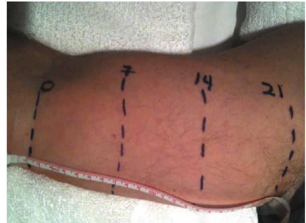 Figure 11 - PICC Zone Insertion Method™ (ZIM™): A Systematic