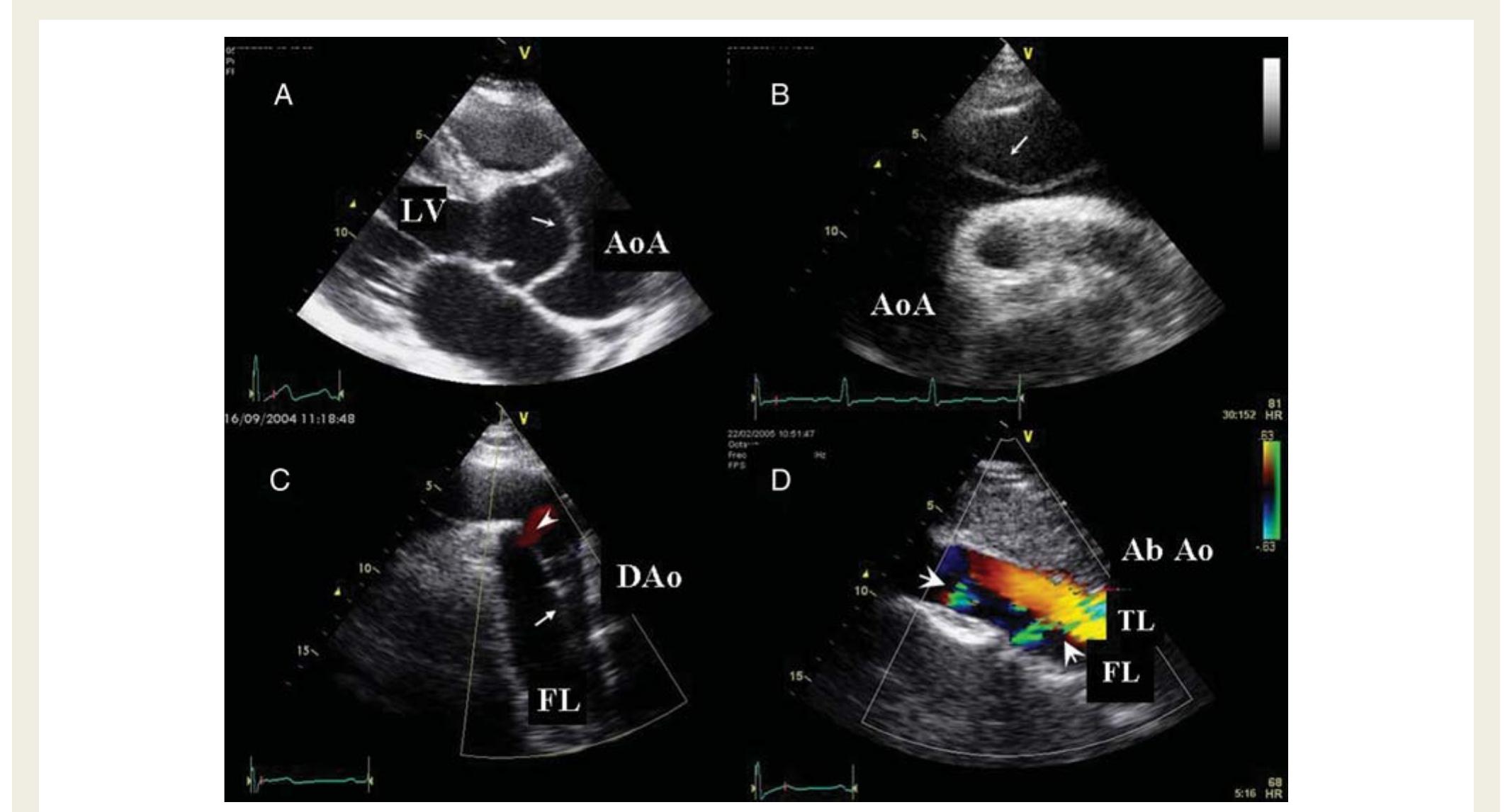 Aortic dissection diagnosis by transthoracic