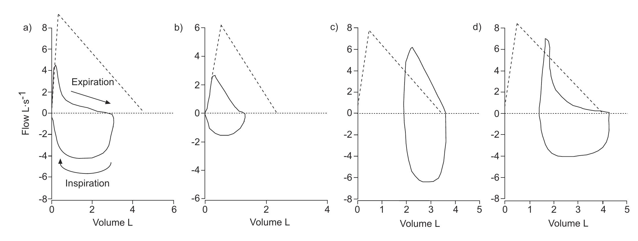 A, b) examples of obstructive pulmonary defects with a low