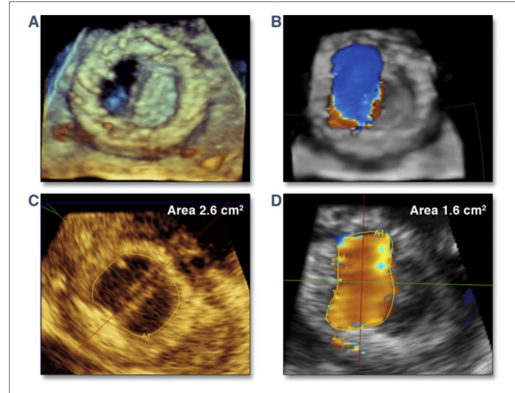 Abnormal mechanical valve function