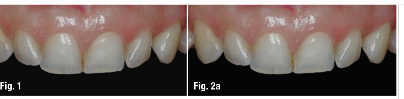 Initial photograph of the anterior teeth prior to