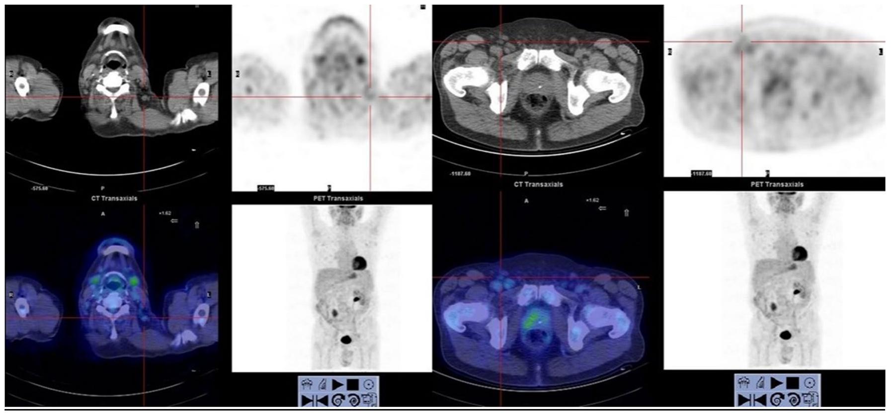 [18f]fdg pet/ct in a patient marginal zone lymphoma: