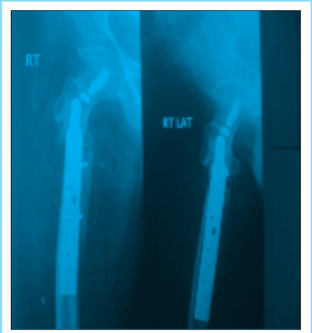-1. implant failure (broken leg screw) two (2.0%) patients