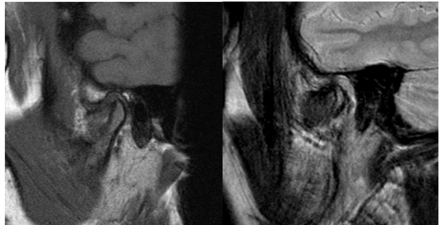 Pre-treatment tmj mri fig. 1: pre-treatment sagittal t1 (a)