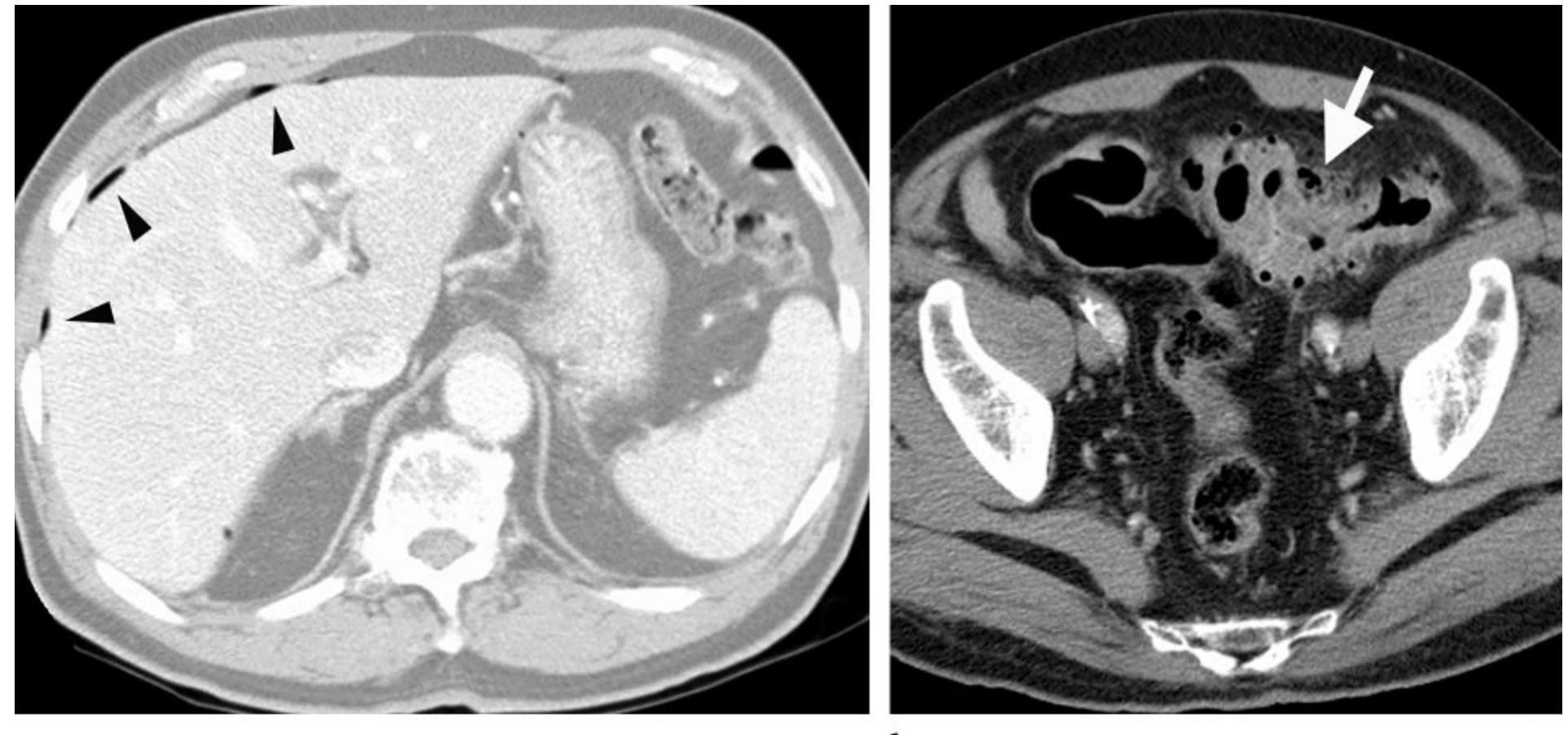 (PDF) The Perihepatic Space: Comprehensive Anatomy and CT Features of ...