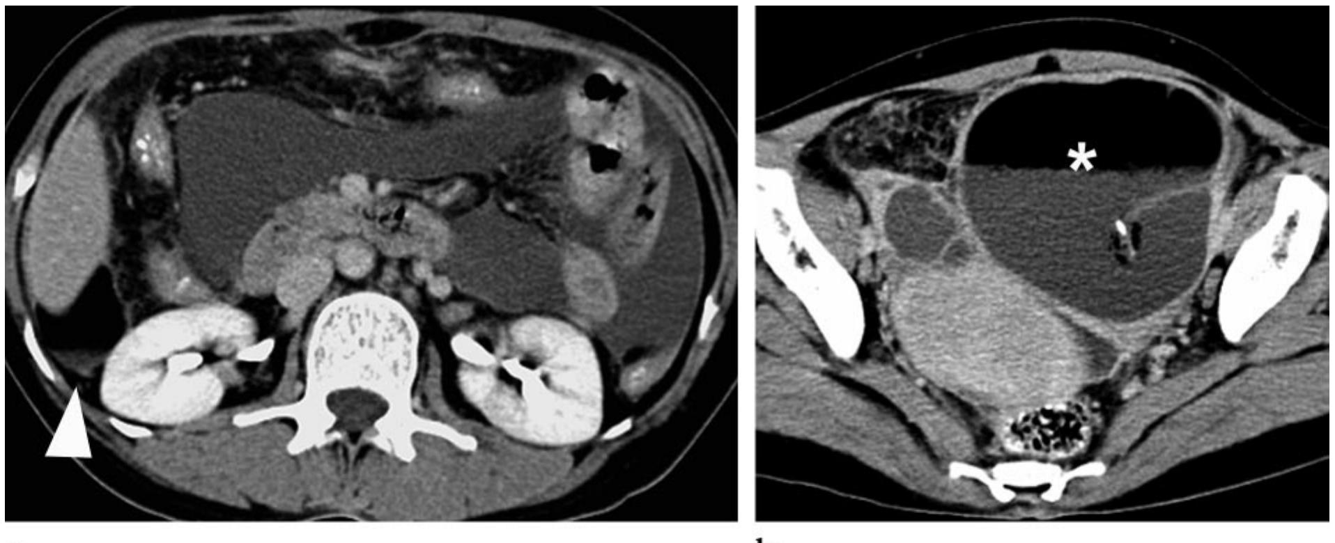 (PDF) The Perihepatic Space: Comprehensive Anatomy and CT Features of ...