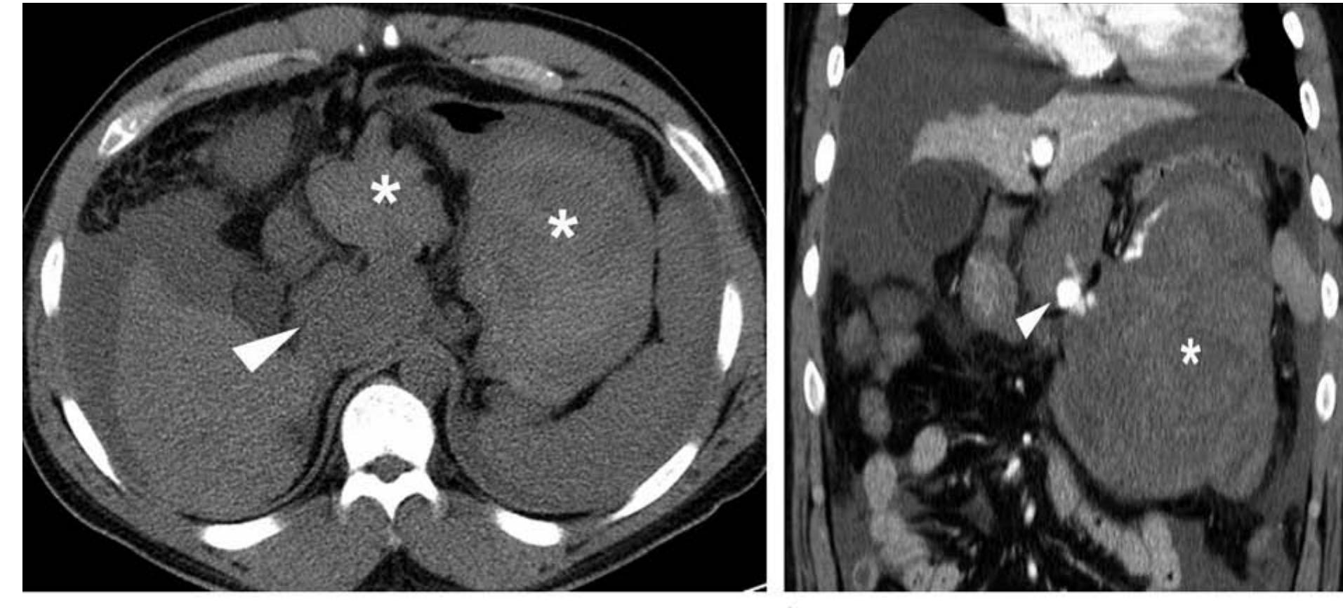(PDF) The Perihepatic Space: Comprehensive Anatomy and CT Features of ...