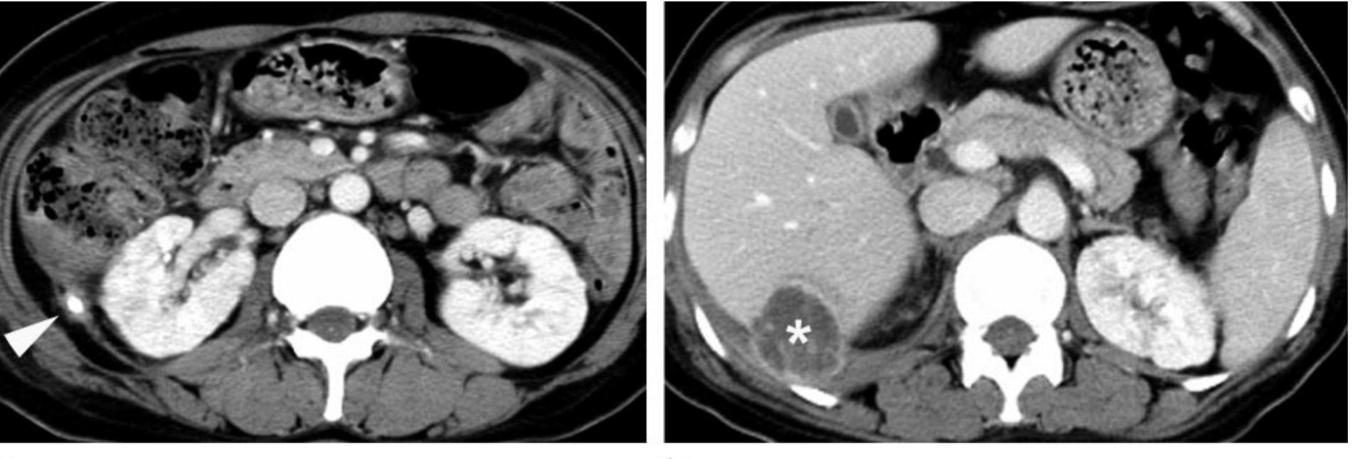 (PDF) The Perihepatic Space: Comprehensive Anatomy and CT Features of ...