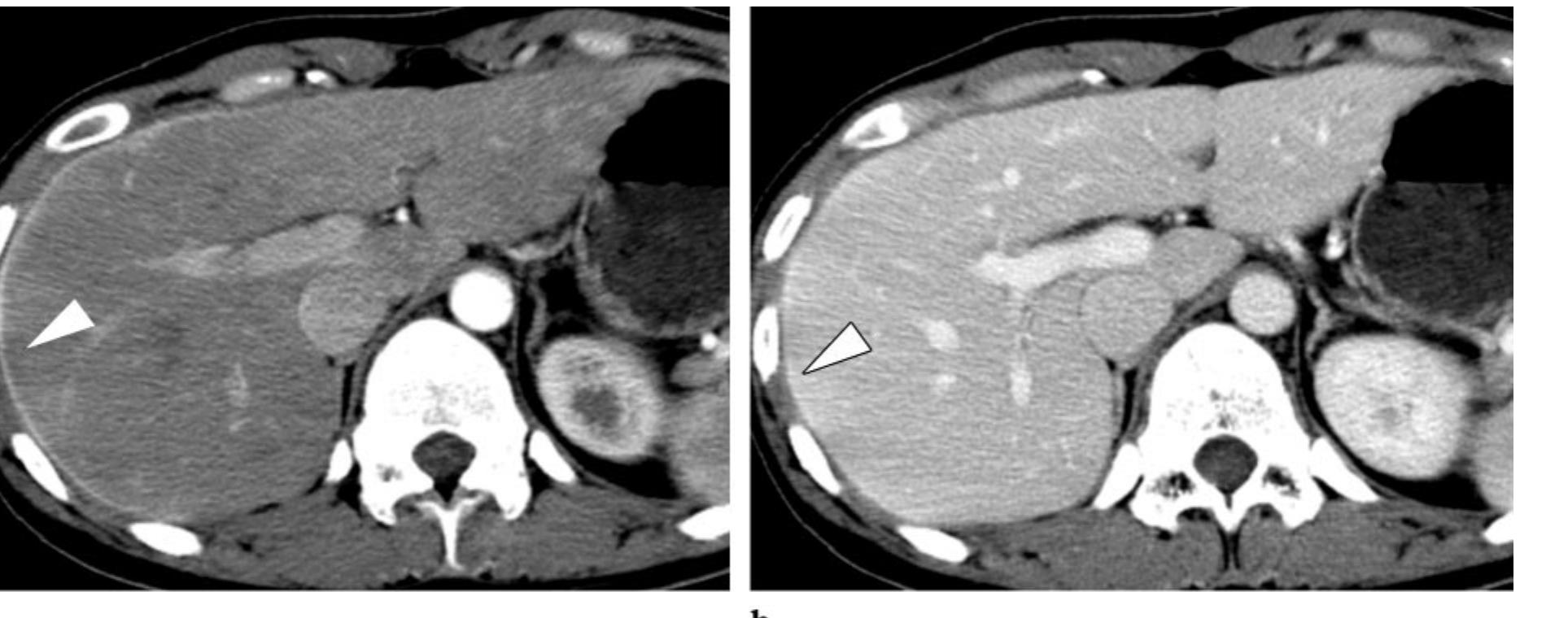 (PDF) The Perihepatic Space: Comprehensive Anatomy and CT Features of ...
