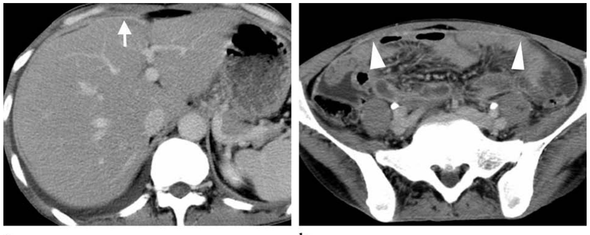 (PDF) The Perihepatic Space: Comprehensive Anatomy and CT Features of ...