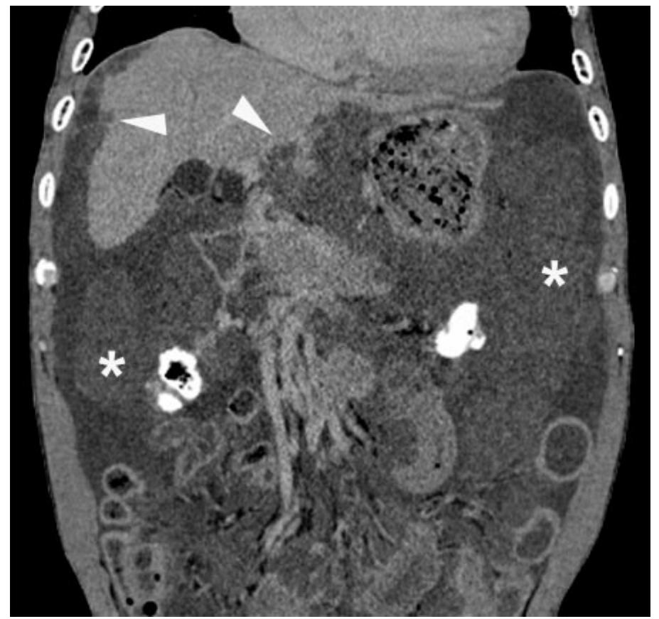 (PDF) The Perihepatic Space: Comprehensive Anatomy and CT Features of ...