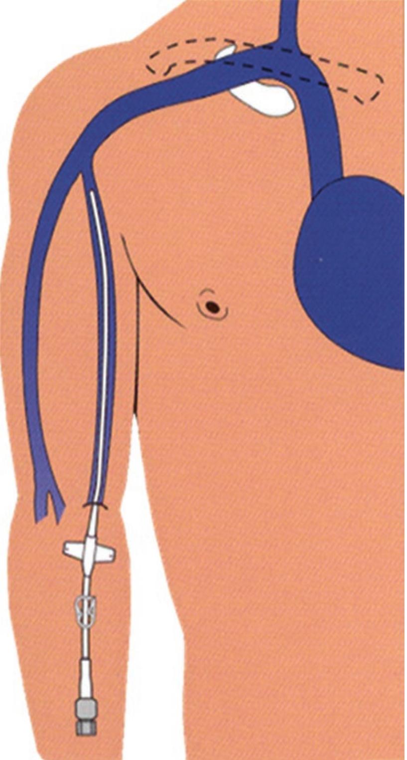 7. placement of a midline catheter (used with permission n.