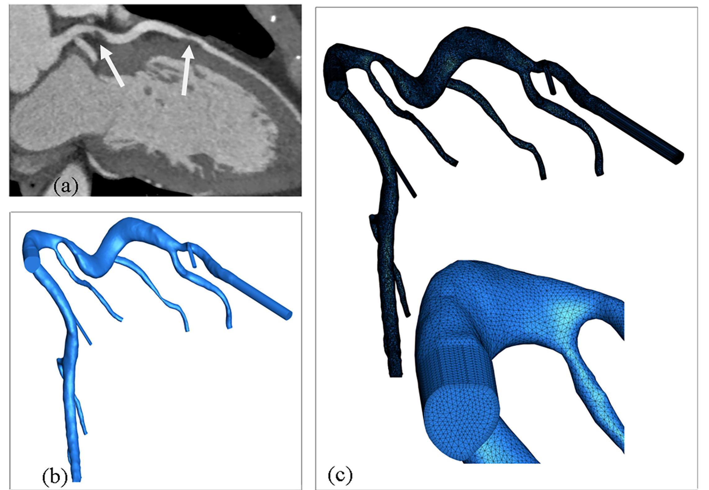 (a) coronary cta images for a 52-years-old man, which showed