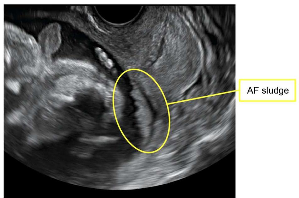 Ultrasound image showing amniotic fluid sludge in a