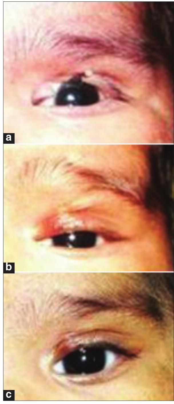 Figure 4 - Reconstructions of eyelid defects