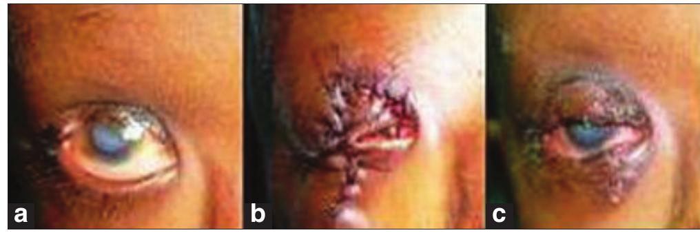 (a) moderate-sized defect of the upper eyelid. (b)