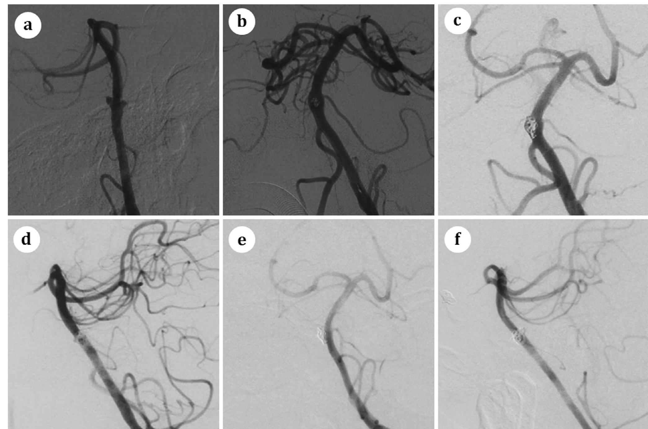 (PDF) Treatment of fenestrated vertebrobasilar junction-related ...