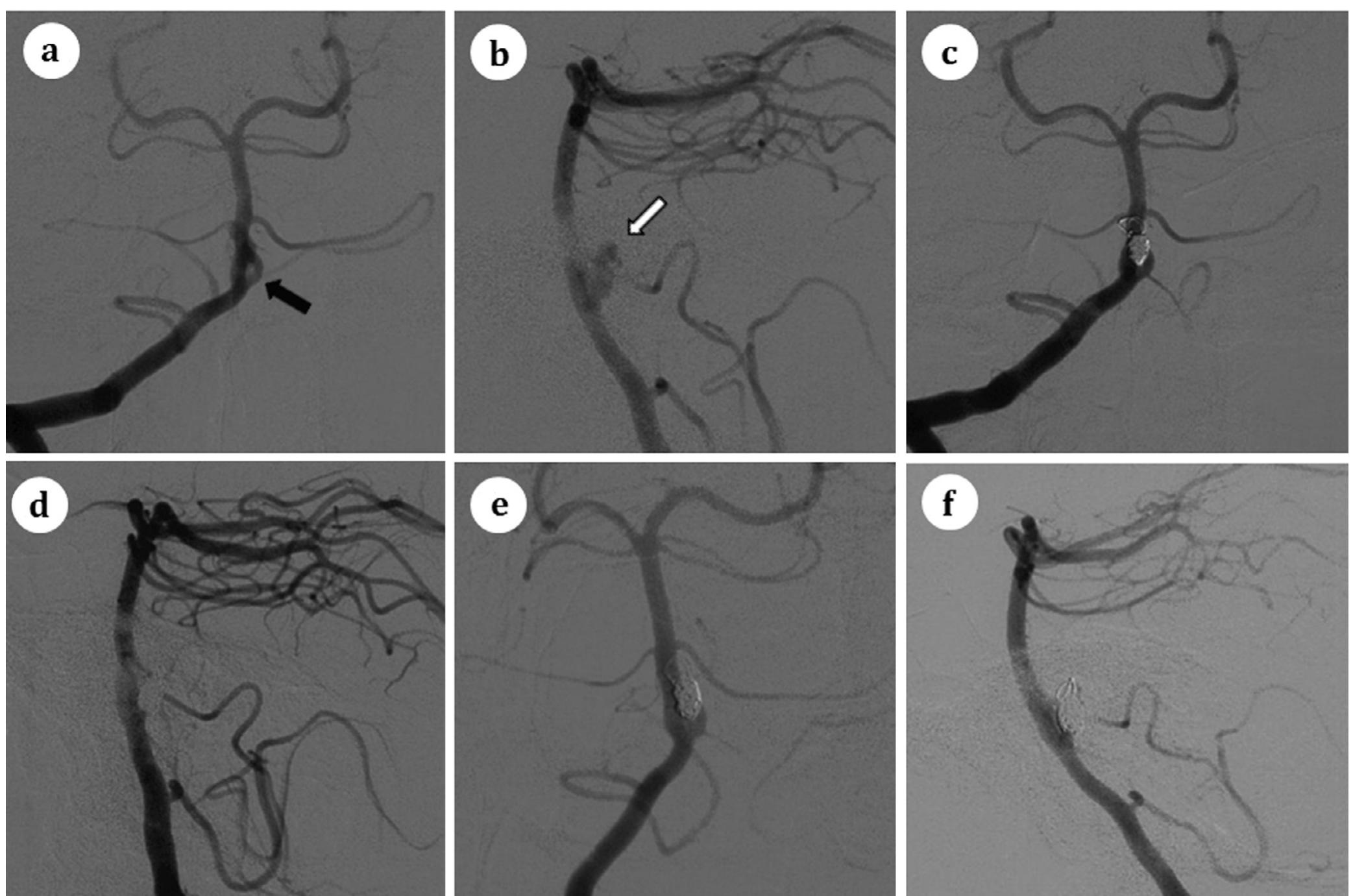 (PDF) Treatment of fenestrated vertebrobasilar junction-related ...