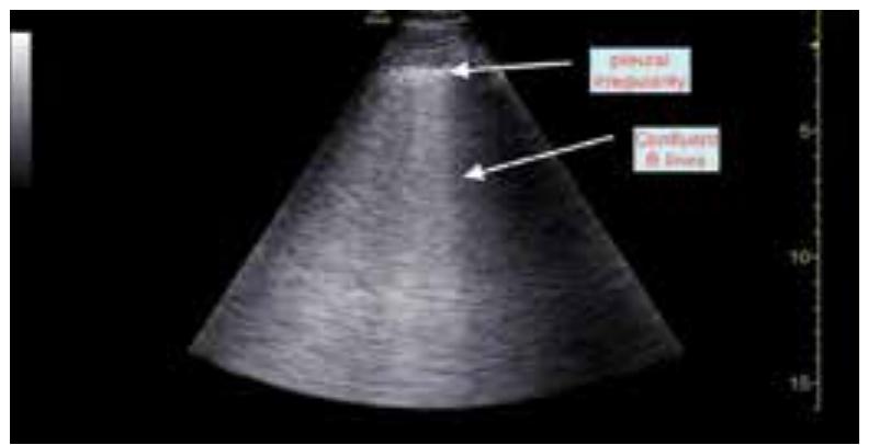 Lung ultrasound, phased array probe, anterior lung field,