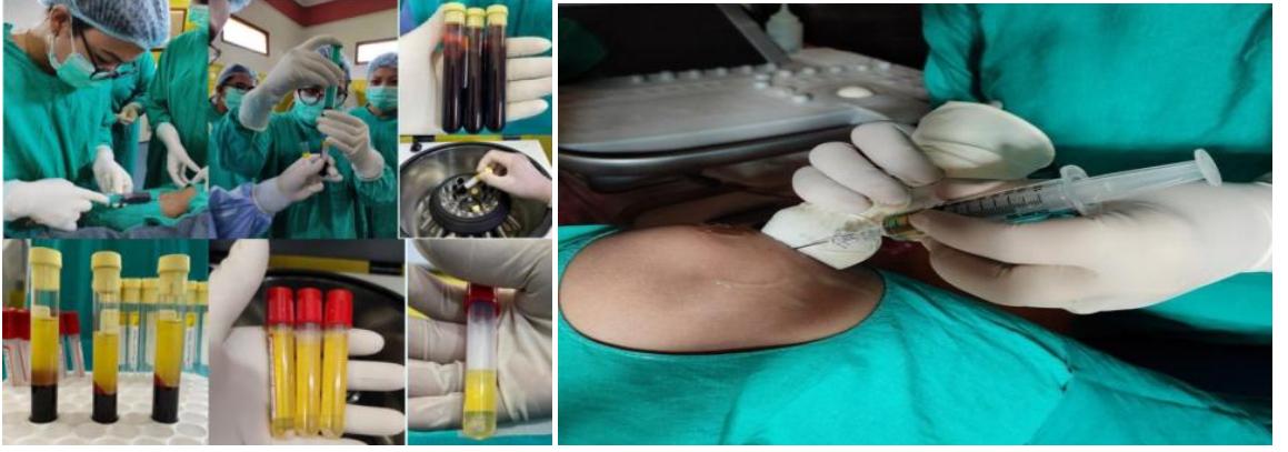 Steps of prp preparation fig. 2. ultrasound guided prp