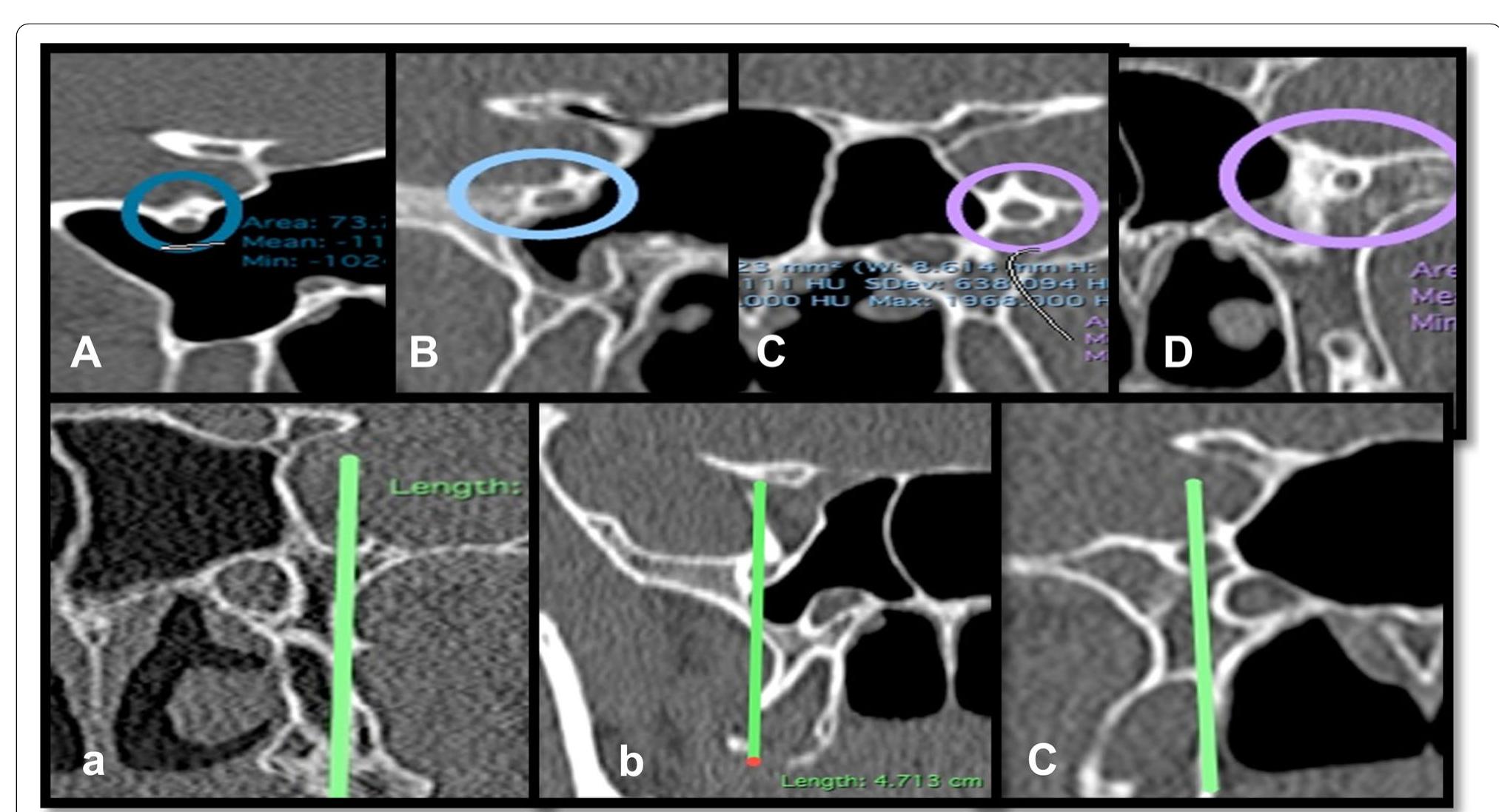 Types and positions of foramen rotundum. a type |, b type