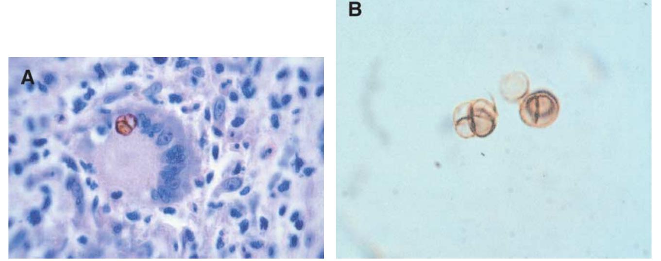 (a) langerhans’ cell containing a muriform cell. h & e