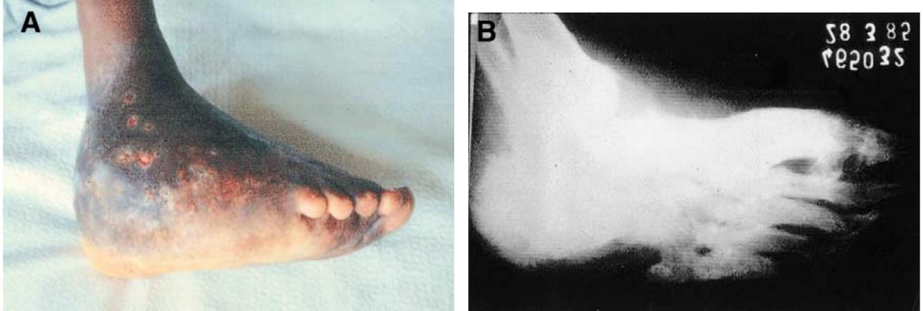 (a) mycetoma foot lesion. (b) radiograph of same lesion with