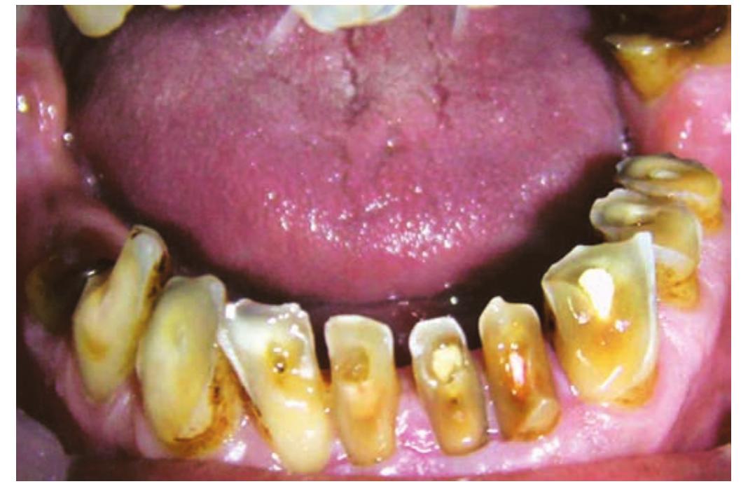 C: mandibular occlusal view fig. 1b: maxillary occlusal