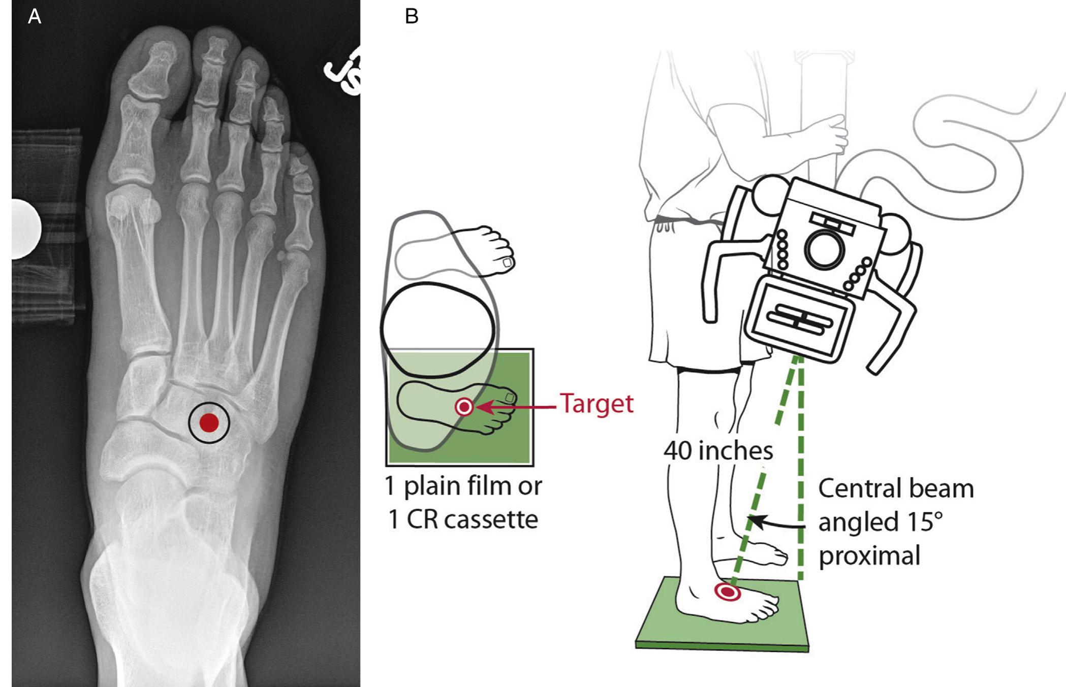 (PDF) Normal Foot and Ankle Radiographic Angles, Measurements, and ...