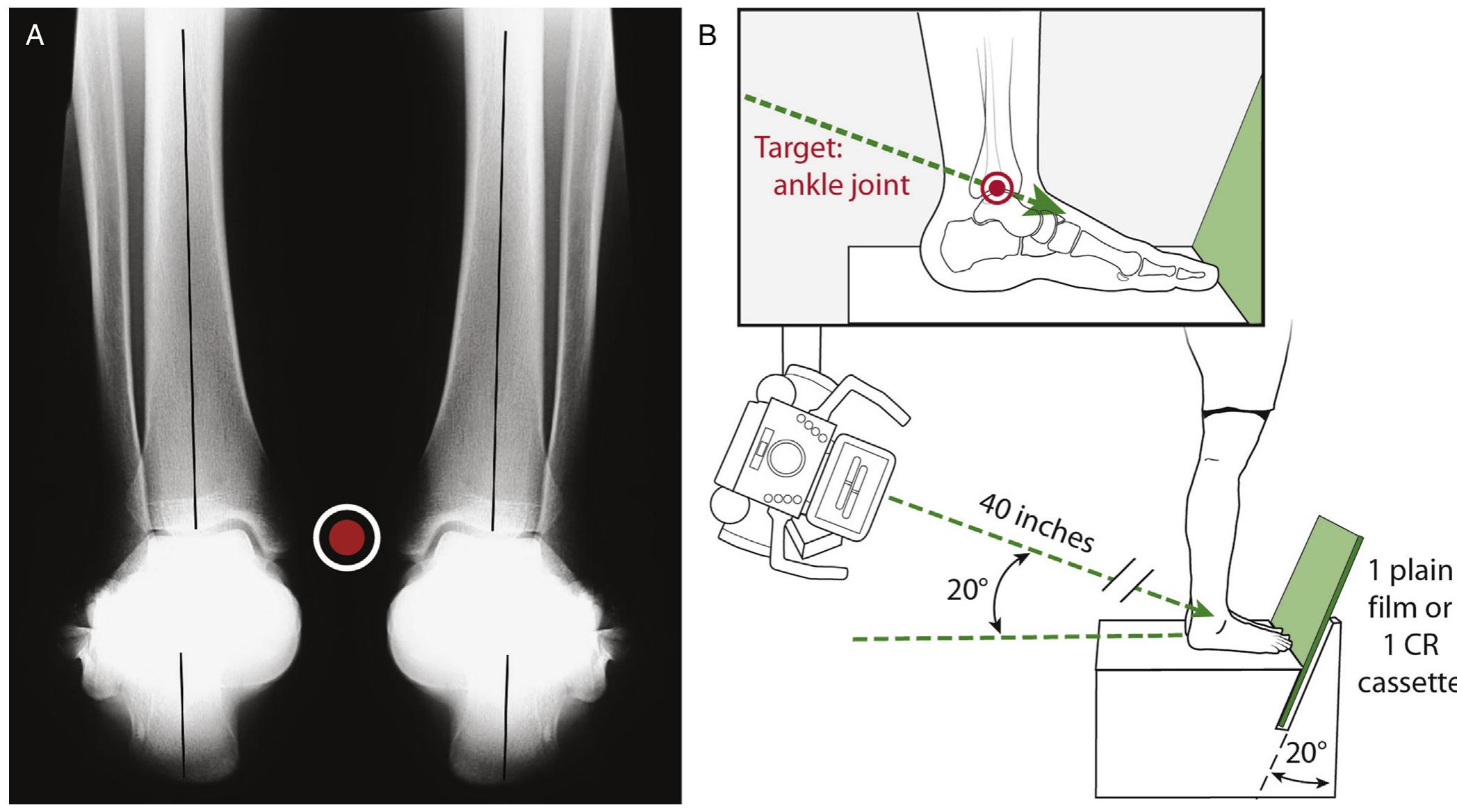 (a) well-positioned hindfoot alignment view radiograph. note