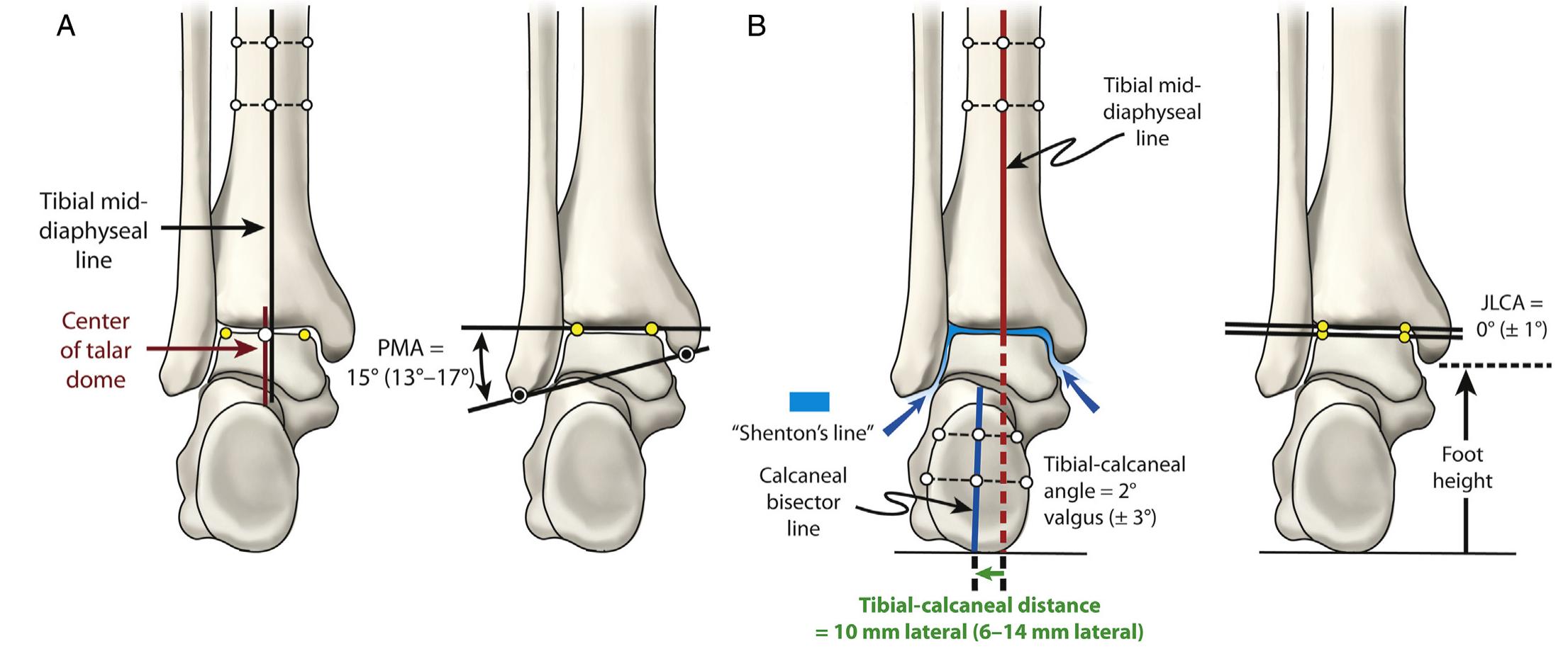 (PDF) Normal Foot and Ankle Radiographic Angles, Measurements, and ...