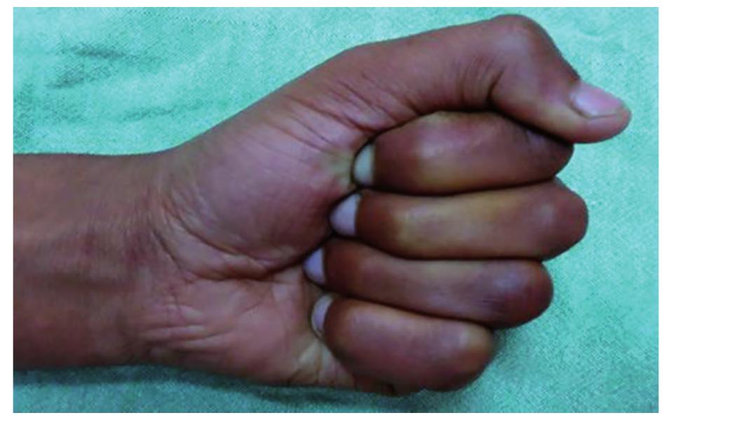 Figure 8 - Management of Flexor Tendon Injuries in Hand