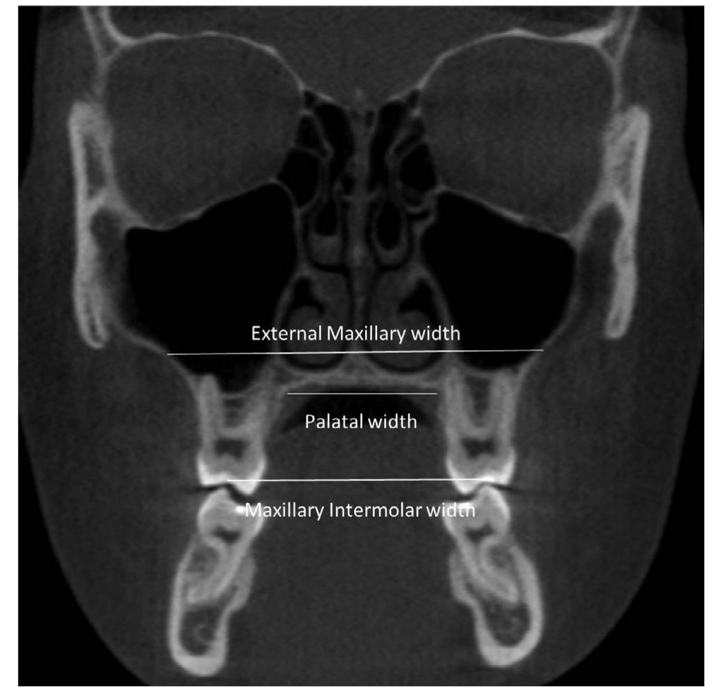 Measurement of maxillary intermolar width, palatal width,