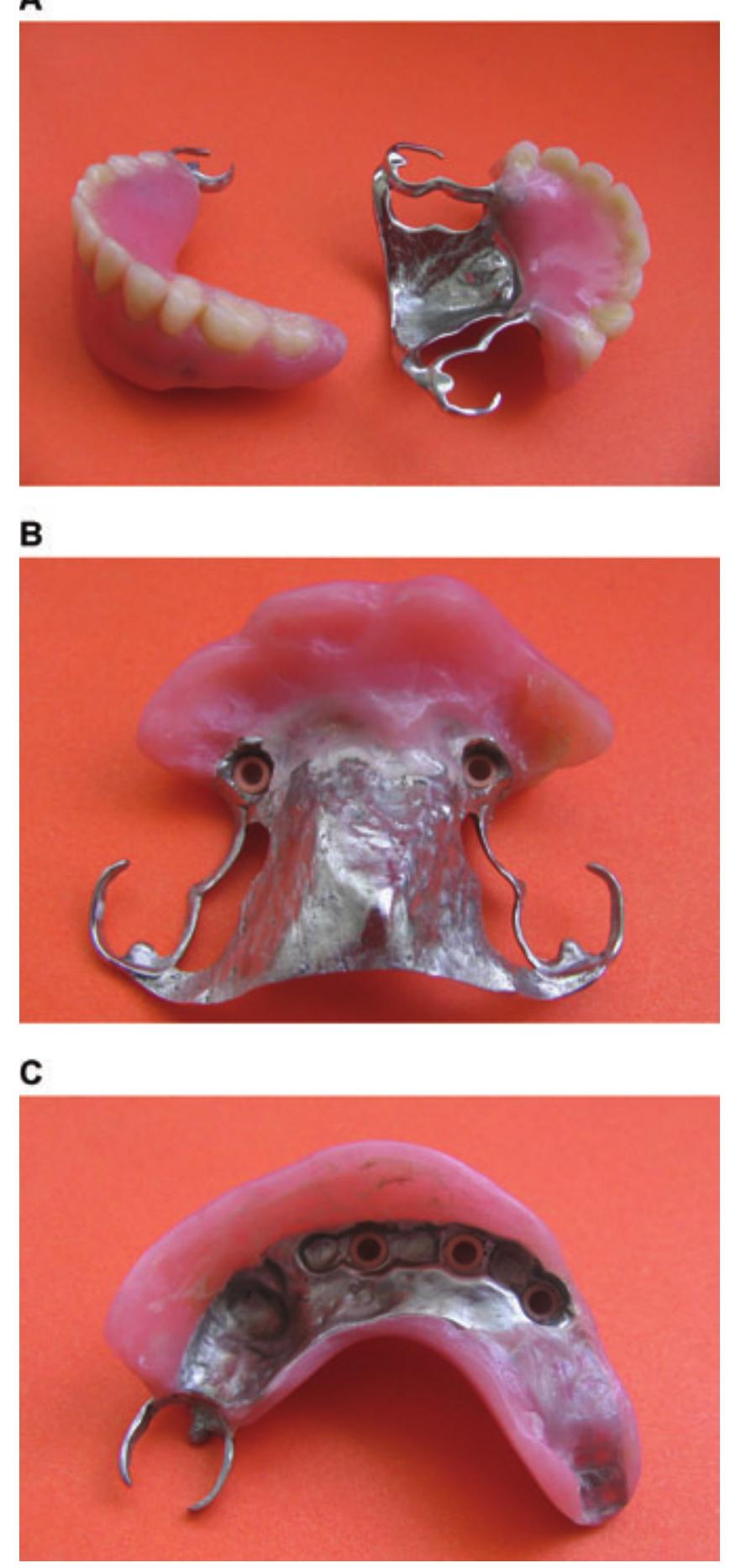 (a) maxillary and mandibular rpds. (b) intaglio surface of