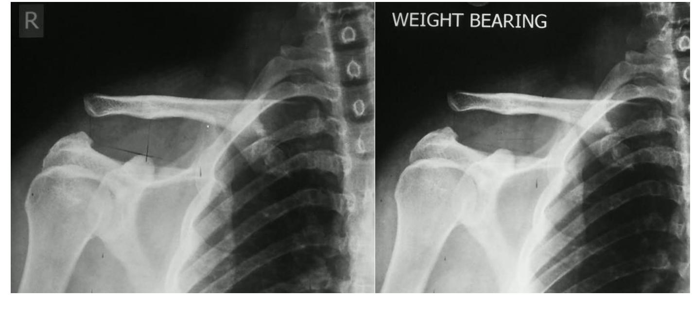Figure 2 - Outcome of fixation of acromioclavicular joint