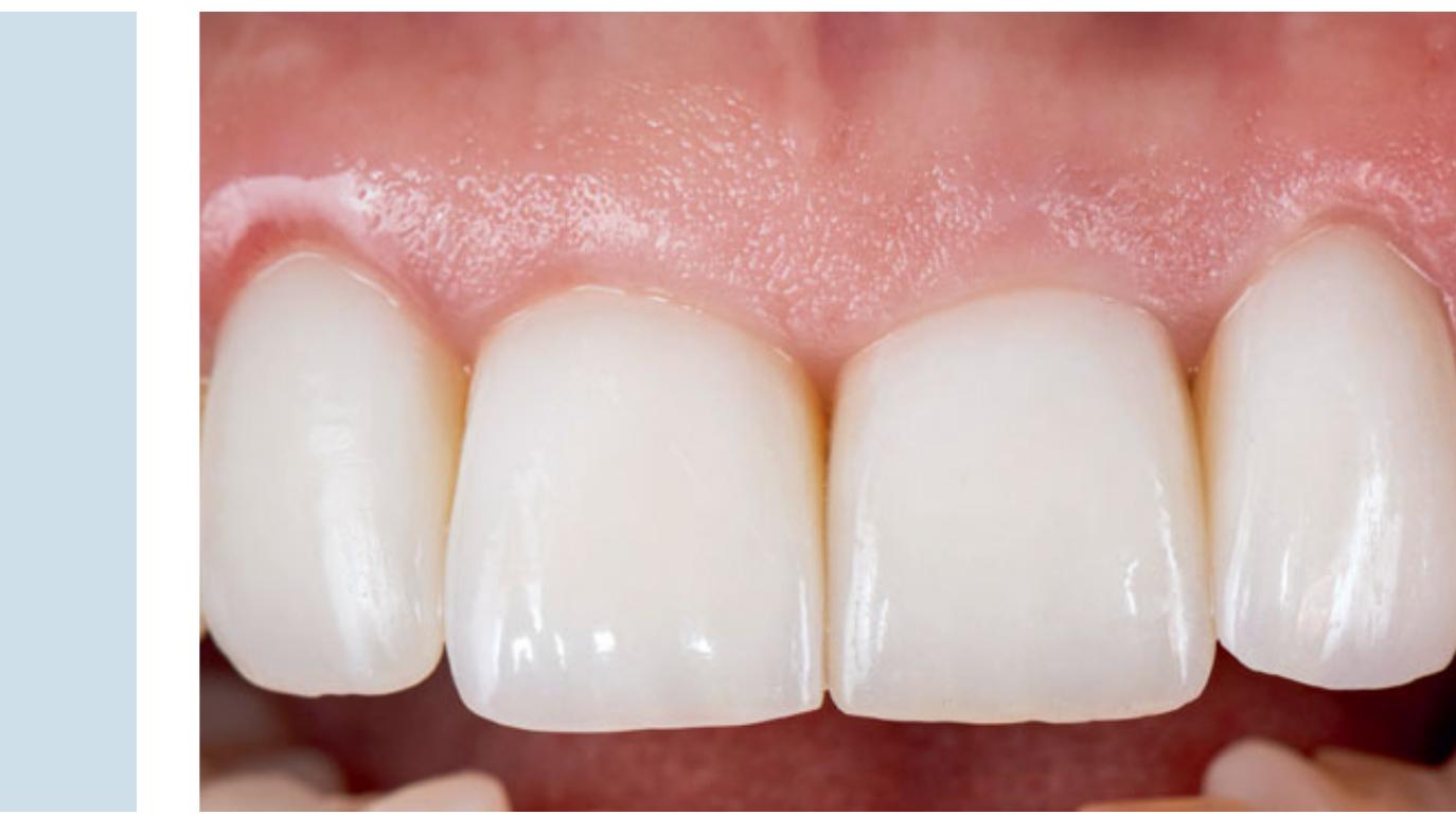 Shield preparation before implant placement. notice the