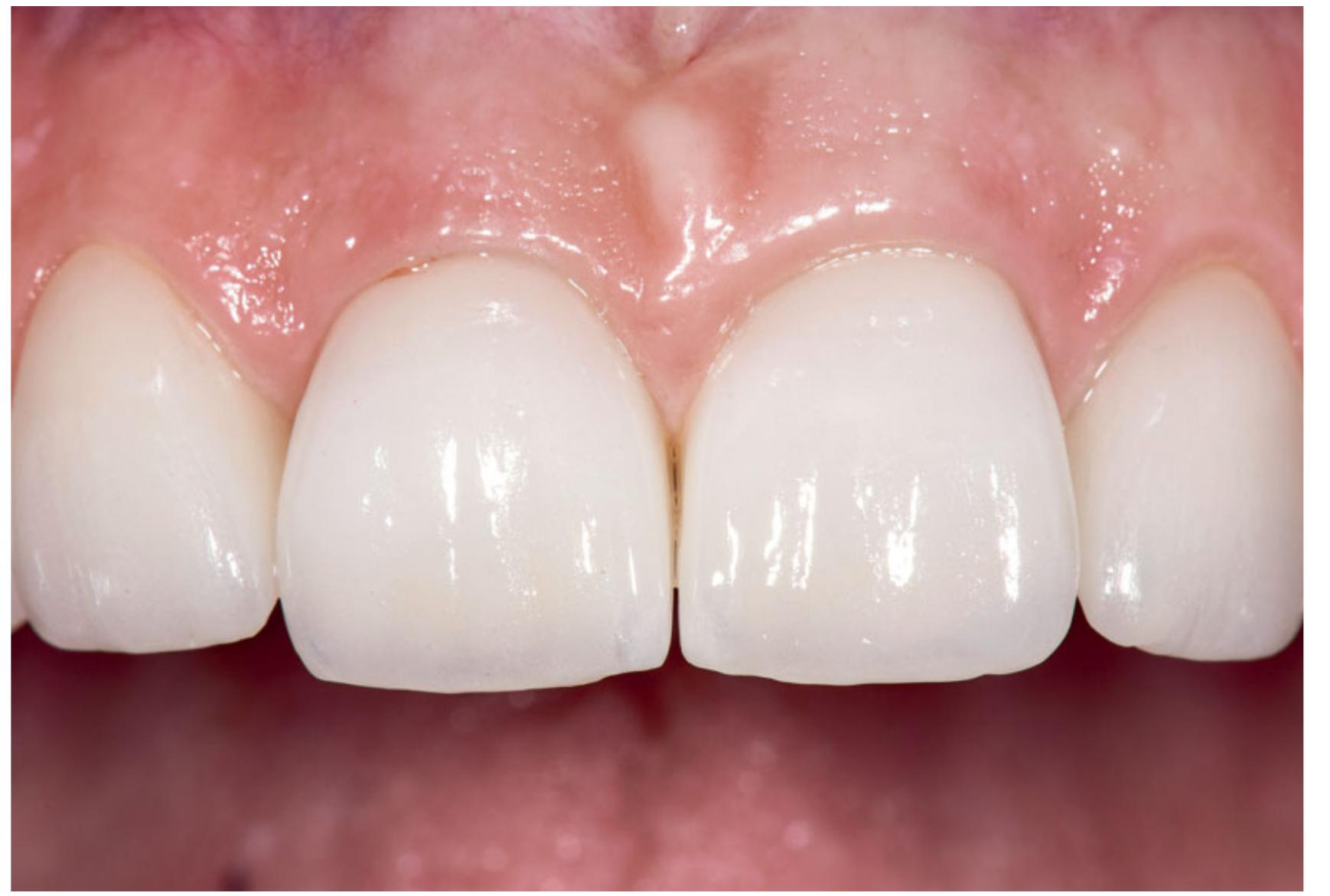 Preoperative view of a socket-shield case with two adjacent